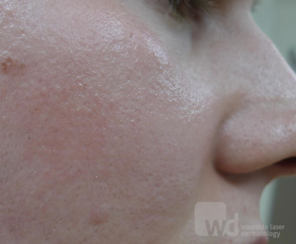 Pore Size Reduction - Dr Davin Lim