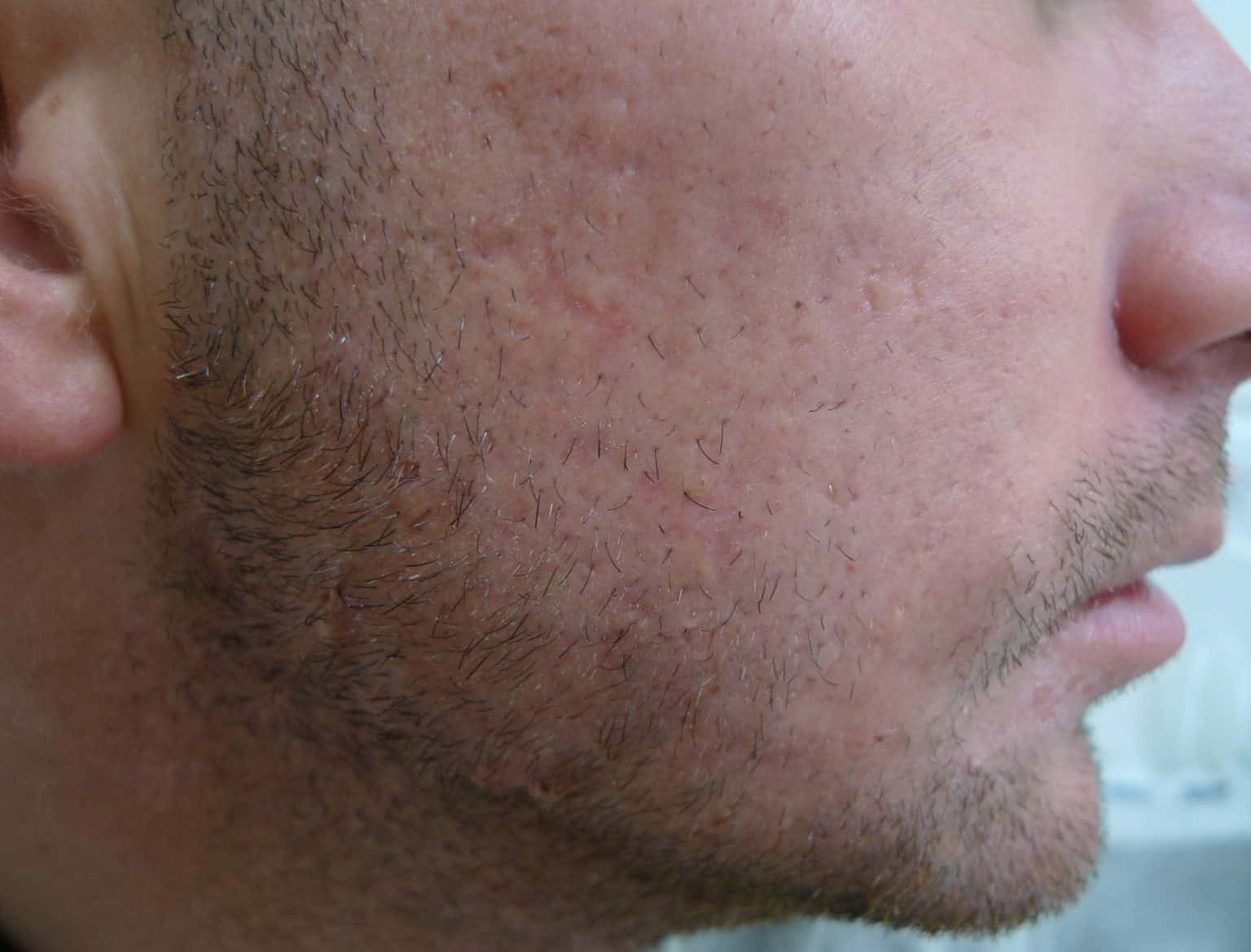 Professional Roaccutane Treatment In Australia - Dr Davin Lim