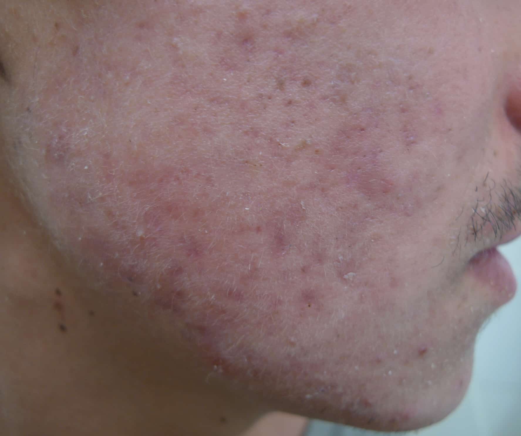 Acne Scar Treatments On Accutane / Oratane - Dr Davin Lim