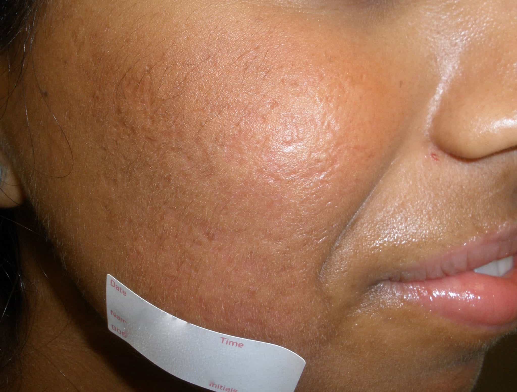 Professional Roaccutane Treatment In Australia - Dr Davin Lim