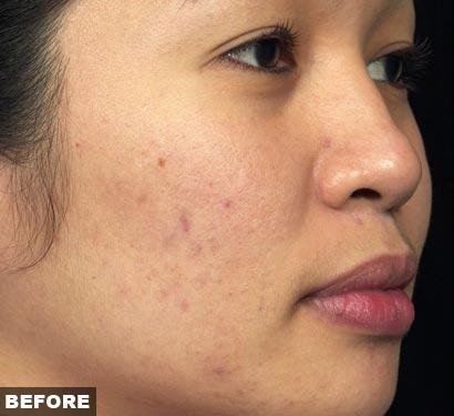 Best Asian And Ethnic Skin Rejuvenation Treatment In Australia