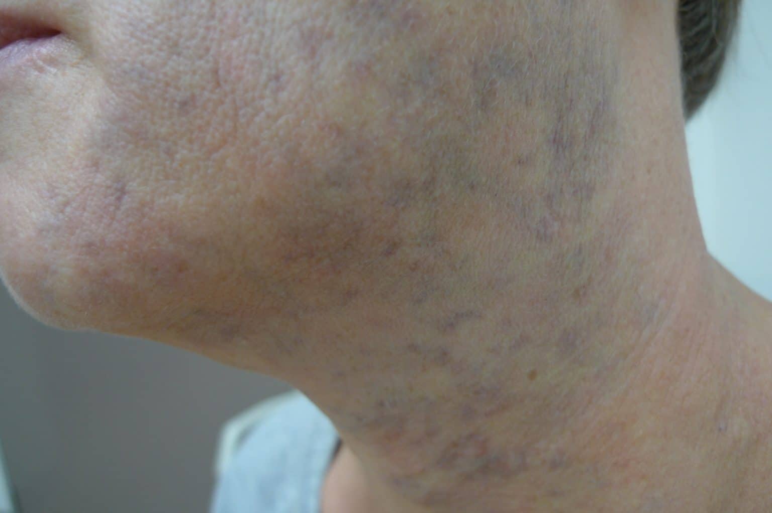 Professional Port Wine Stains Treatment In Australia