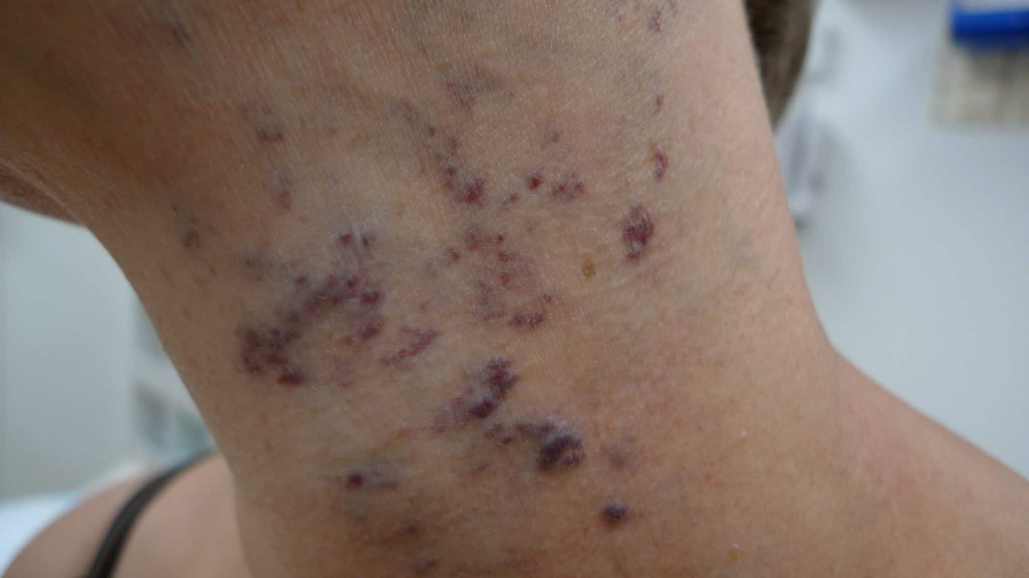 Professional Port Wine Stains Treatment In Australia