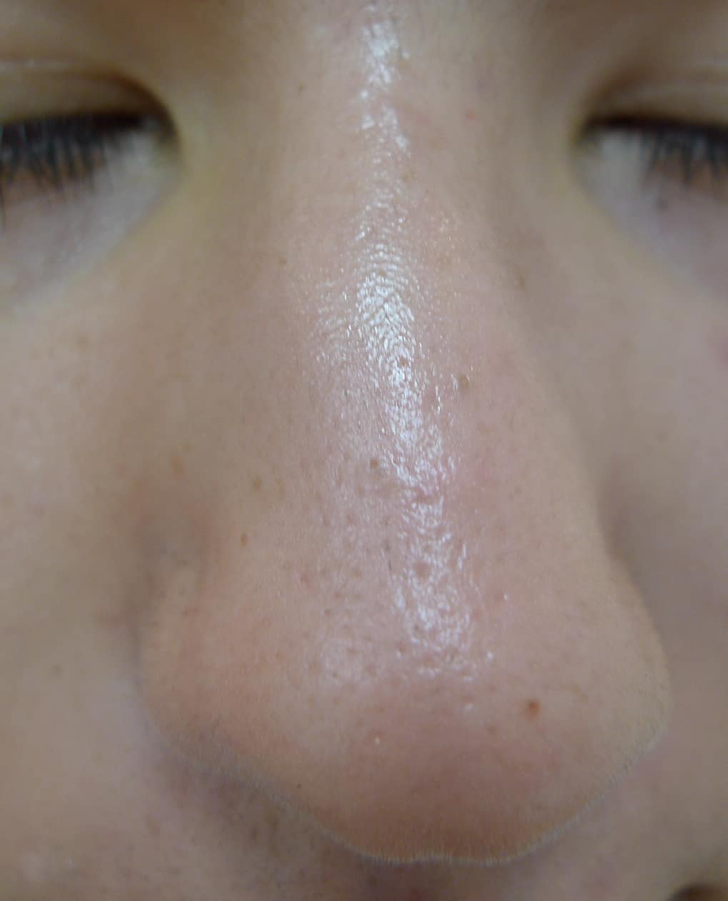 Best Oily Skin Treatments In Australia | Dr Davin Lim