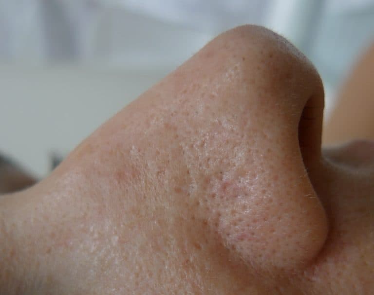 Pore Size Reduction - Dr Davin Lim