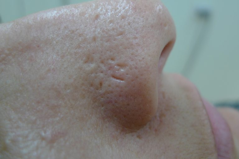 Pore Size Reduction - Dr Davin Lim