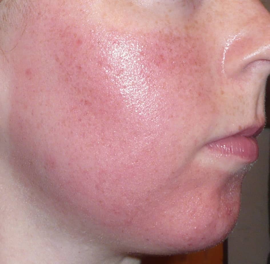 Pore Size Reduction - Dr Davin Lim