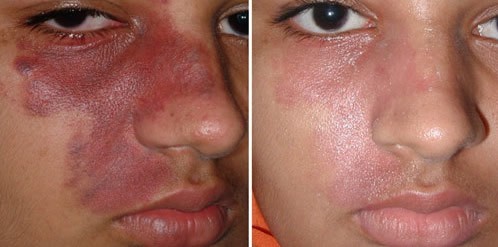 Professional Port Wine Stains Treatment In Australia