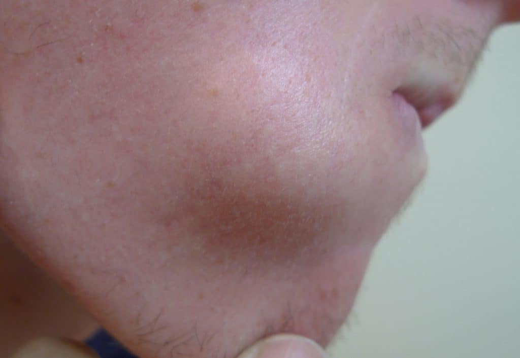 Best Cystic Acne Treatments In Australia | Dr Davin Lim