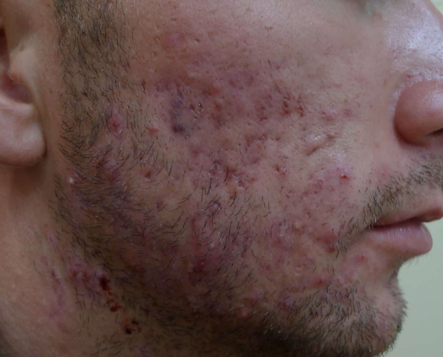 Professional Roaccutane Treatment In Australia - Dr Davin Lim