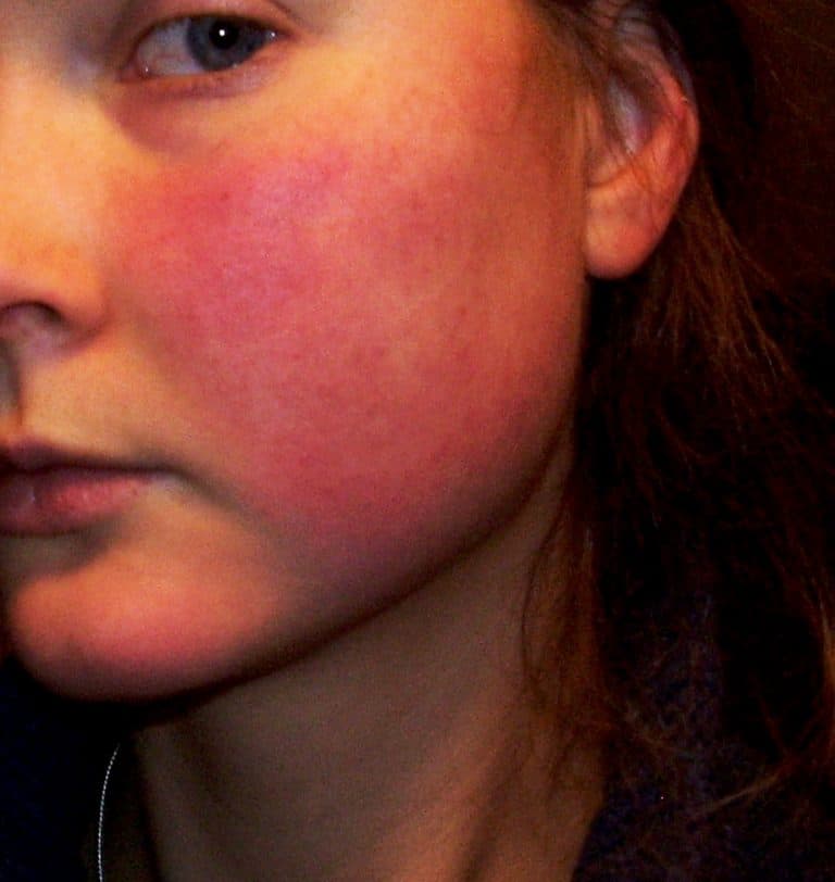 Best Rosacea Treatments In Australia | Dr Davin Lim