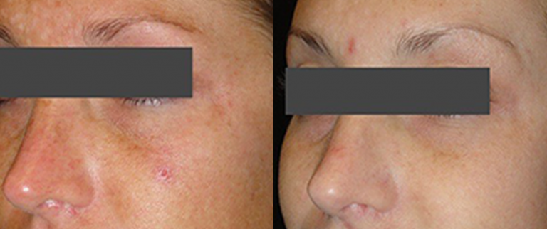Skin Care: Pigmentation Gallery - Dr Davin Lim