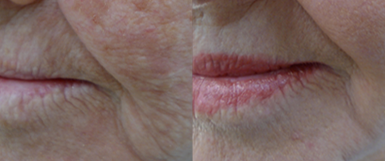 Perioral/Lip Rejuvenation Gallery - Dr Davin Lim