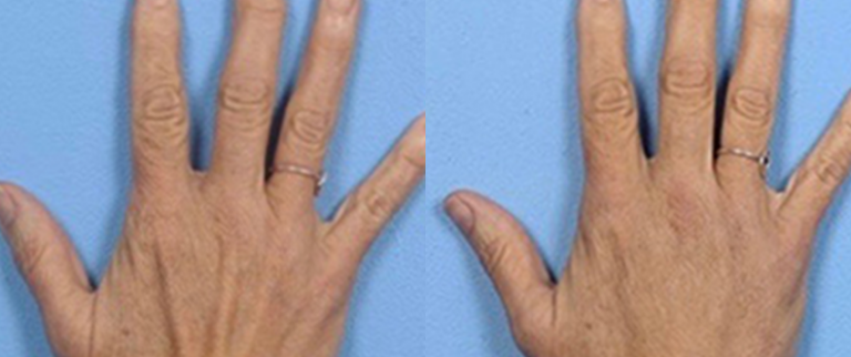 Hand Rejuvenation Gallery - Dr Davin Lim
