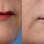 Perioral/Lip Rejuvenation Gallery - Dr Davin Lim
