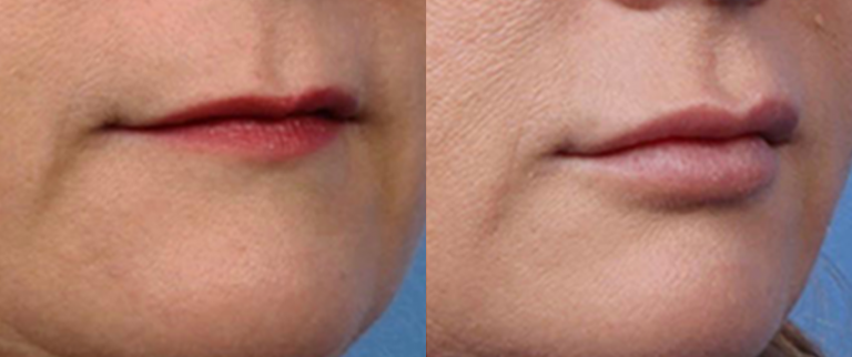 Perioral/Lip Rejuvenation Gallery - Dr Davin Lim