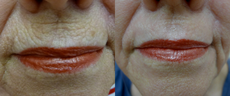 Perioral/Lip Rejuvenation Gallery - Dr Davin Lim
