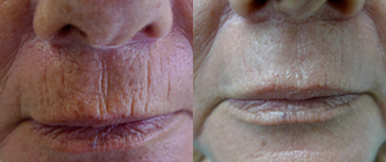Perioral/Lip Rejuvenation Gallery - Dr Davin Lim