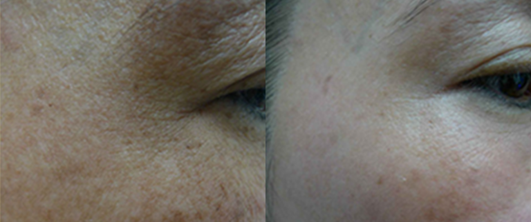 Best Melasma Lasers Treatments In Australia | Dr Davin Lim