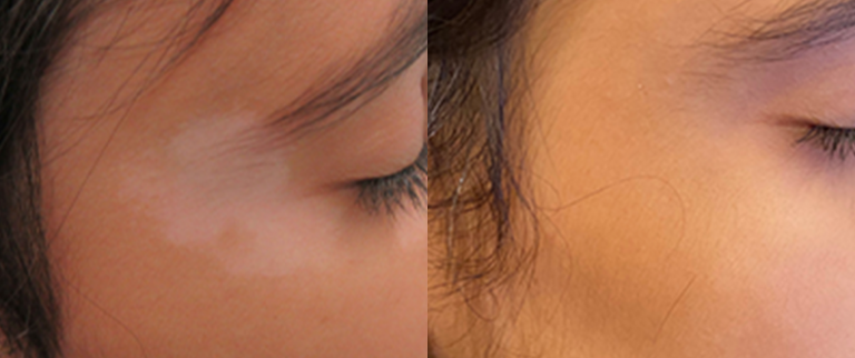 Vitiligo Gallery - Dr Davin Lim