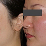 Skin Tightening Gallery - Dr Davin Lim