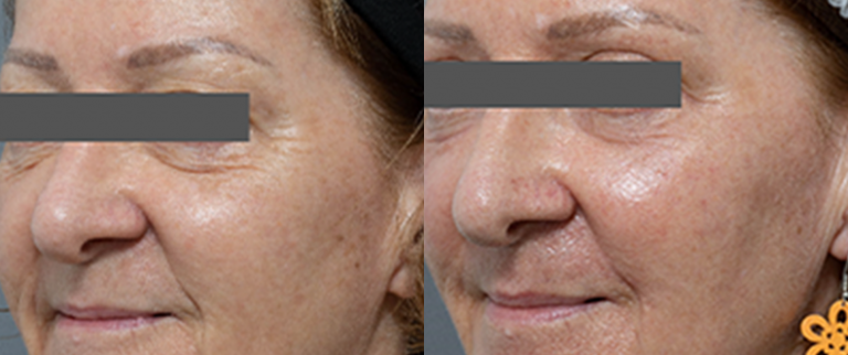Skin Tightening Gallery - Dr Davin Lim