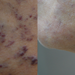 Birthmarks Gallery - Dr Davin Lim