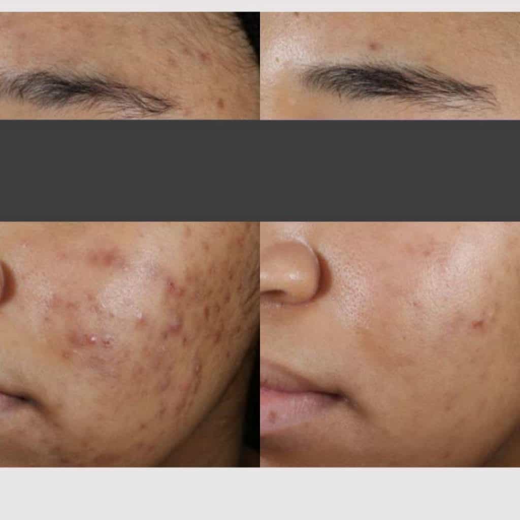 Skin Care: Acne Gallery - Dr Davin Lim