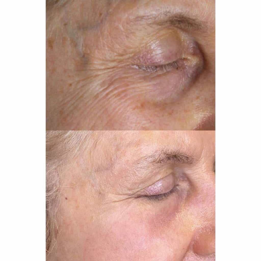 Eye Rejuvenation Gallery - Dr Davin Lim