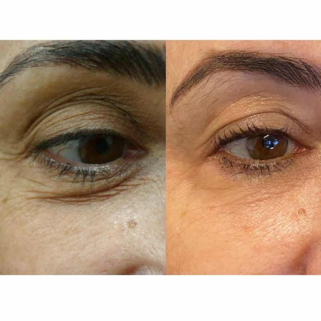 Eye Rejuvenation Gallery - Dr Davin Lim