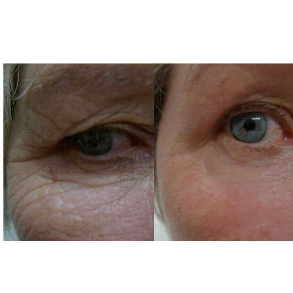 Eye Rejuvenation Gallery - Dr Davin Lim