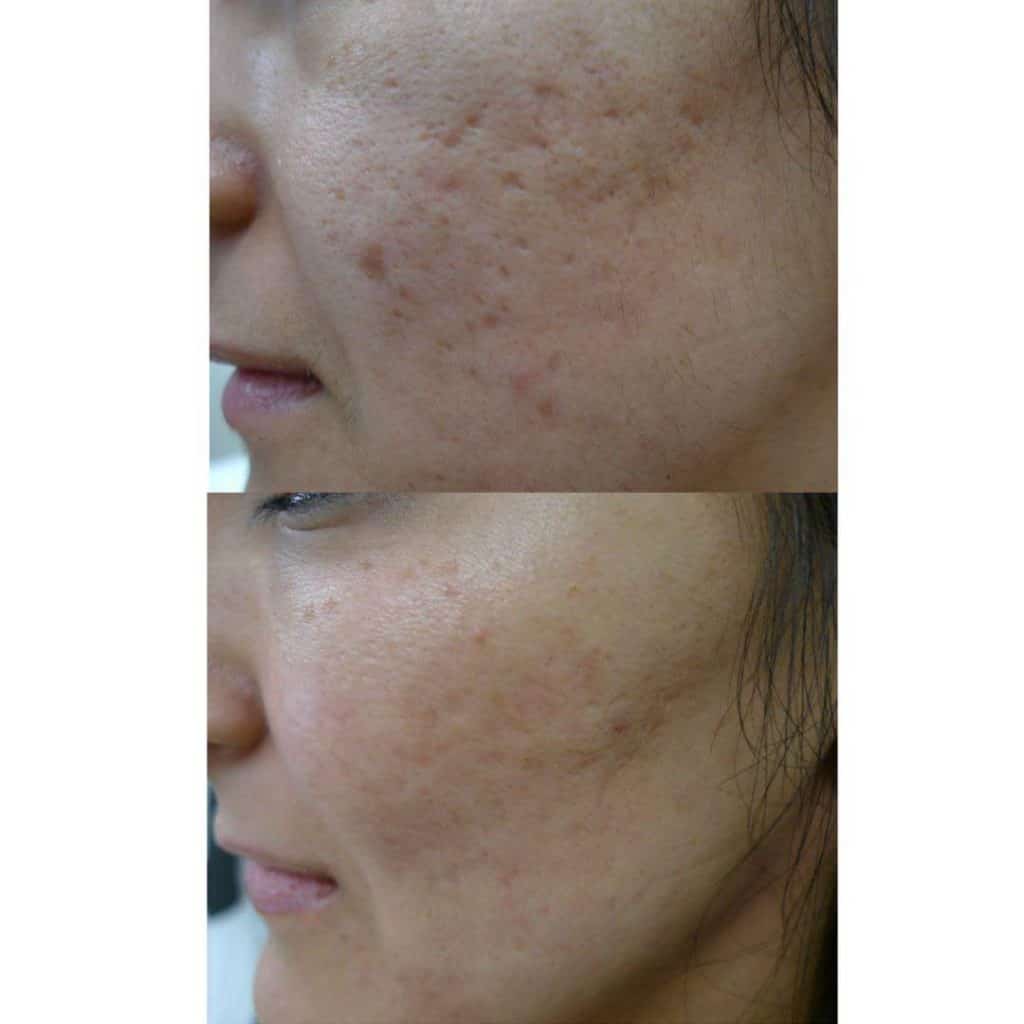Patient Gallery | Acne Scars Gallery | Dr Davin Lim