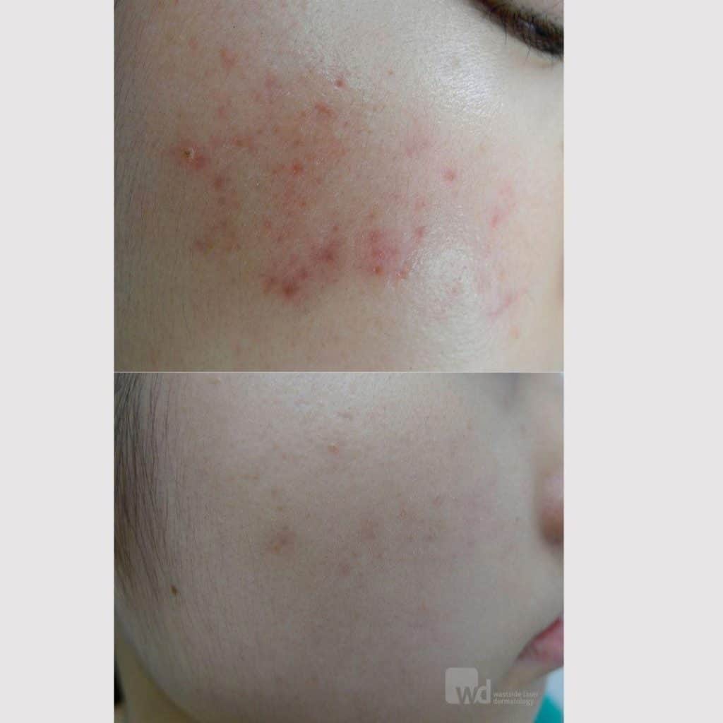 Skin Care: Acne Gallery - Dr Davin Lim