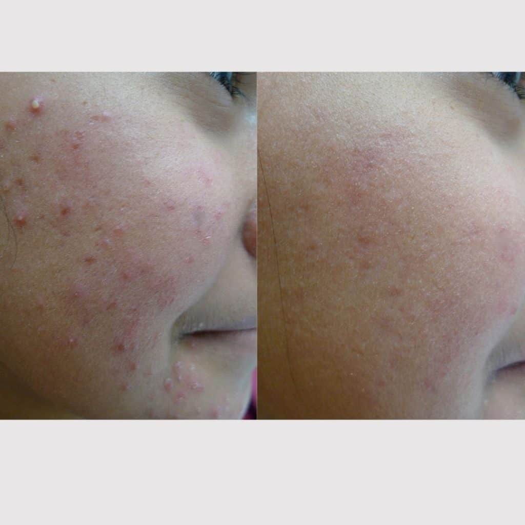 Skin Care: Acne Gallery - Dr Davin Lim