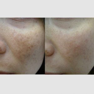 Skin Care: Pigmentation Gallery - Dr Davin Lim