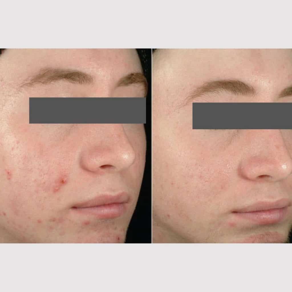 Skin Care: Acne Gallery - Dr Davin Lim
