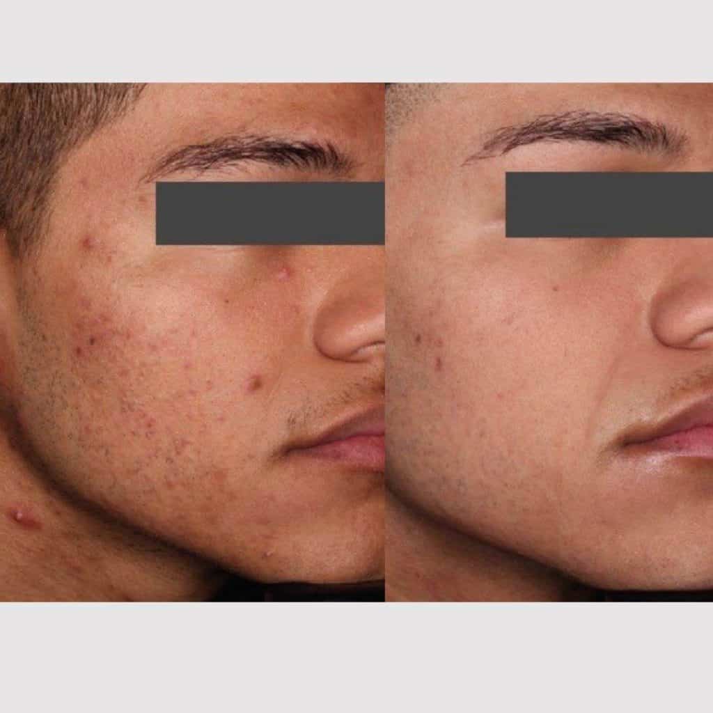 Skin Care: Acne Gallery - Dr Davin Lim