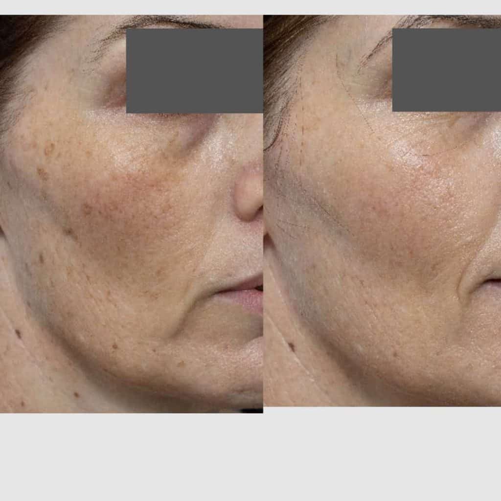 Skin Care: Pigmentation Gallery - Dr Davin Lim