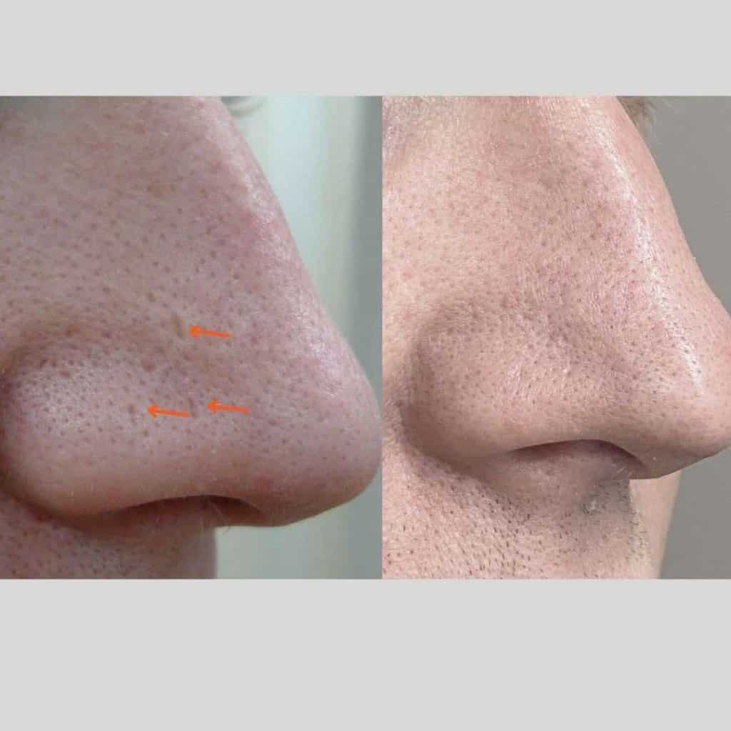 Best Enlarged Pores Treatment In Australia | Dr Davin Lim