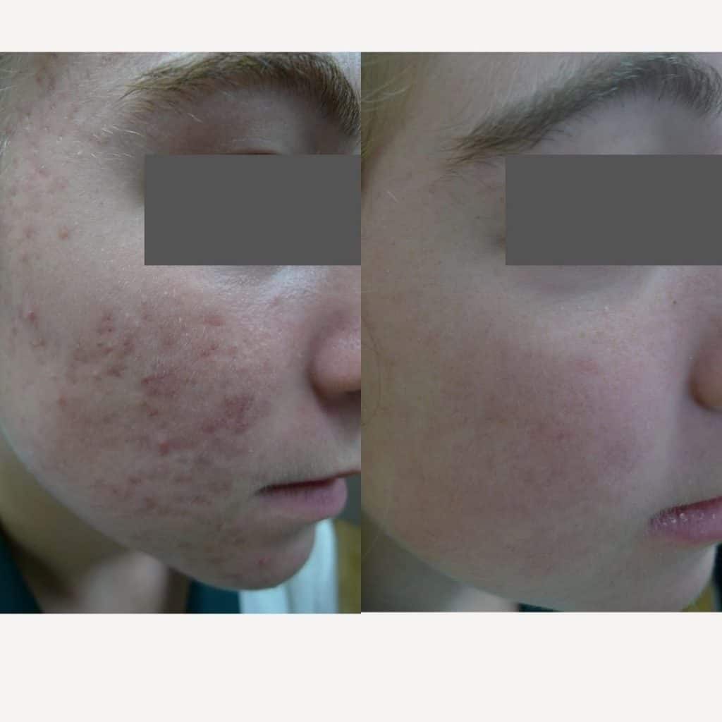 Best Acne Treatments In Australia | Dr Davin Lim