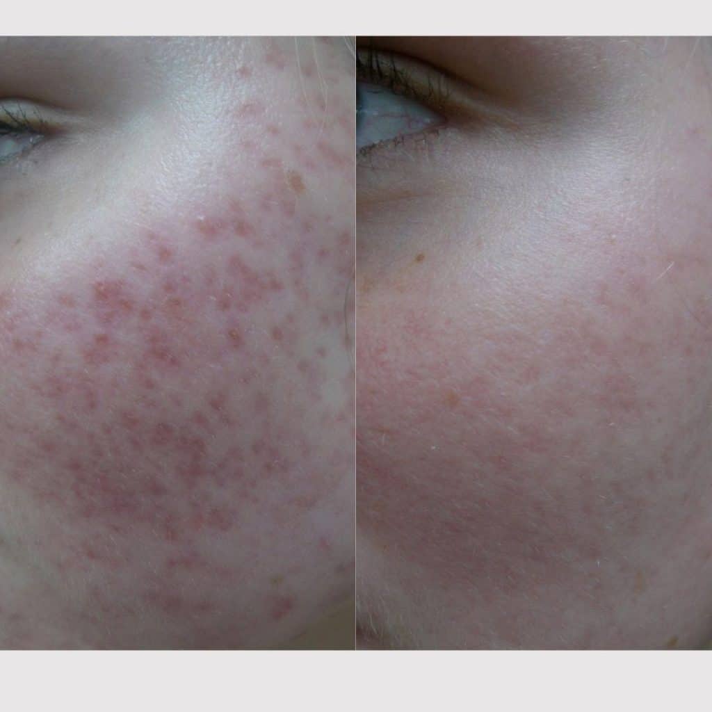 Skin Care: Acne Gallery - Dr Davin Lim