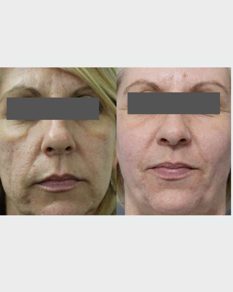 Skin Tightening Gallery - Dr Davin Lim