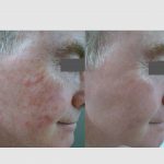 Solaraze Gel - Dr Davin Lim|dermatologist