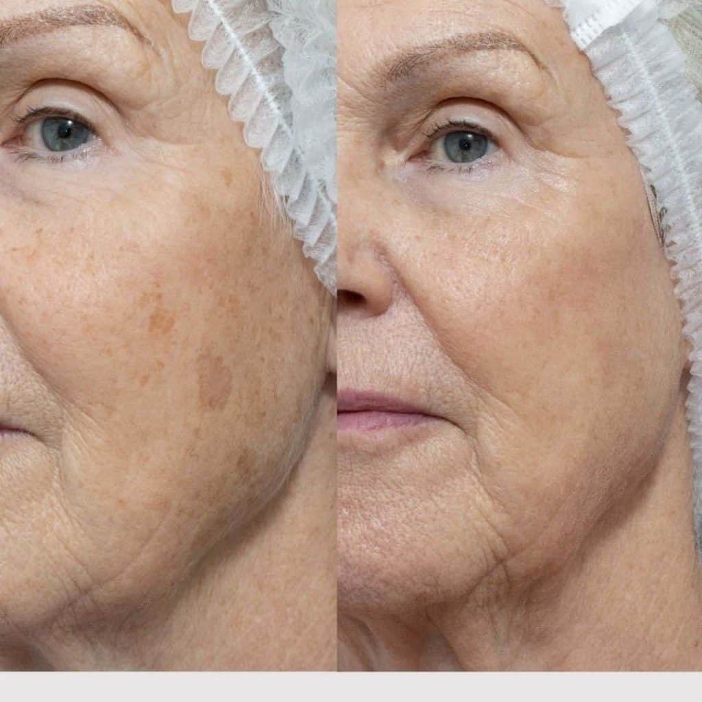 Age Spots Gallery - Dr Davin Lim