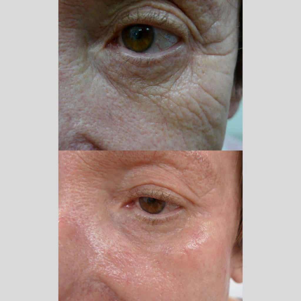 Laser Resurfacing Gallery - Dr Davin Lim