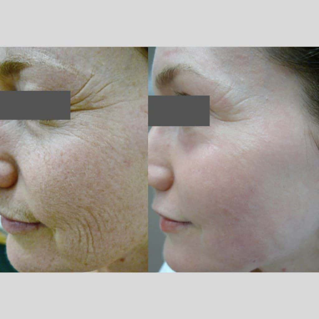 Perioral/Lip Rejuvenation Gallery - Dr Davin Lim