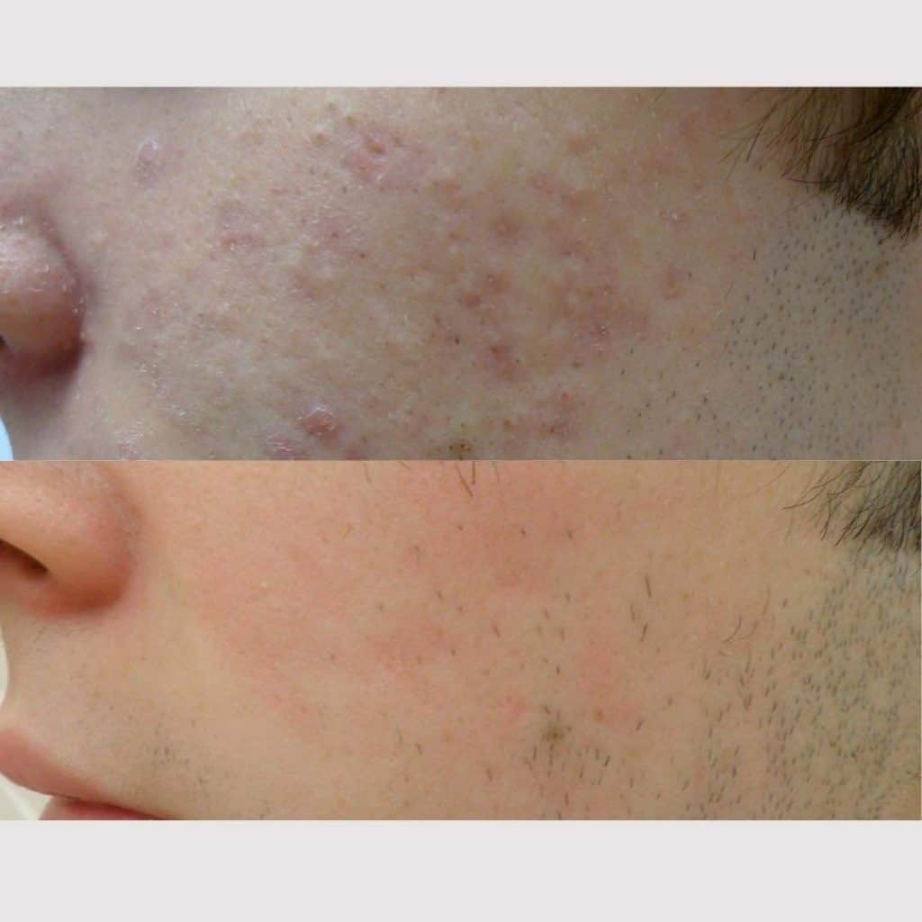 Acne Treatments Gallery - Dr Davin Lim