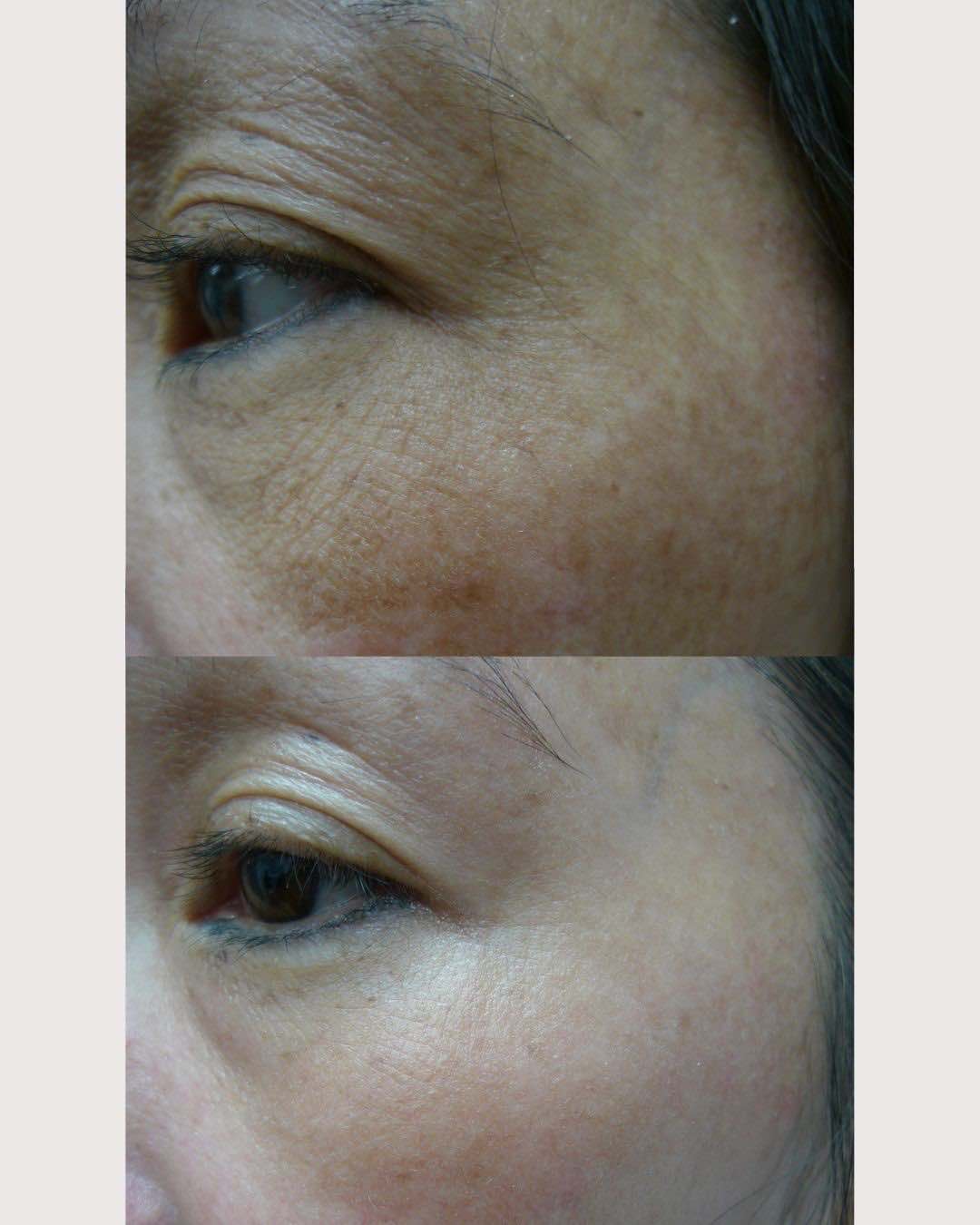 Asian Skin Rejuvenation - Dr Davin Lim