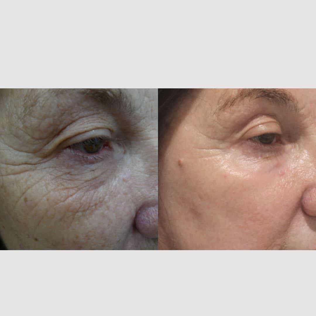 Best Mature Skin Treatments In Australia | Dr Davin Lim