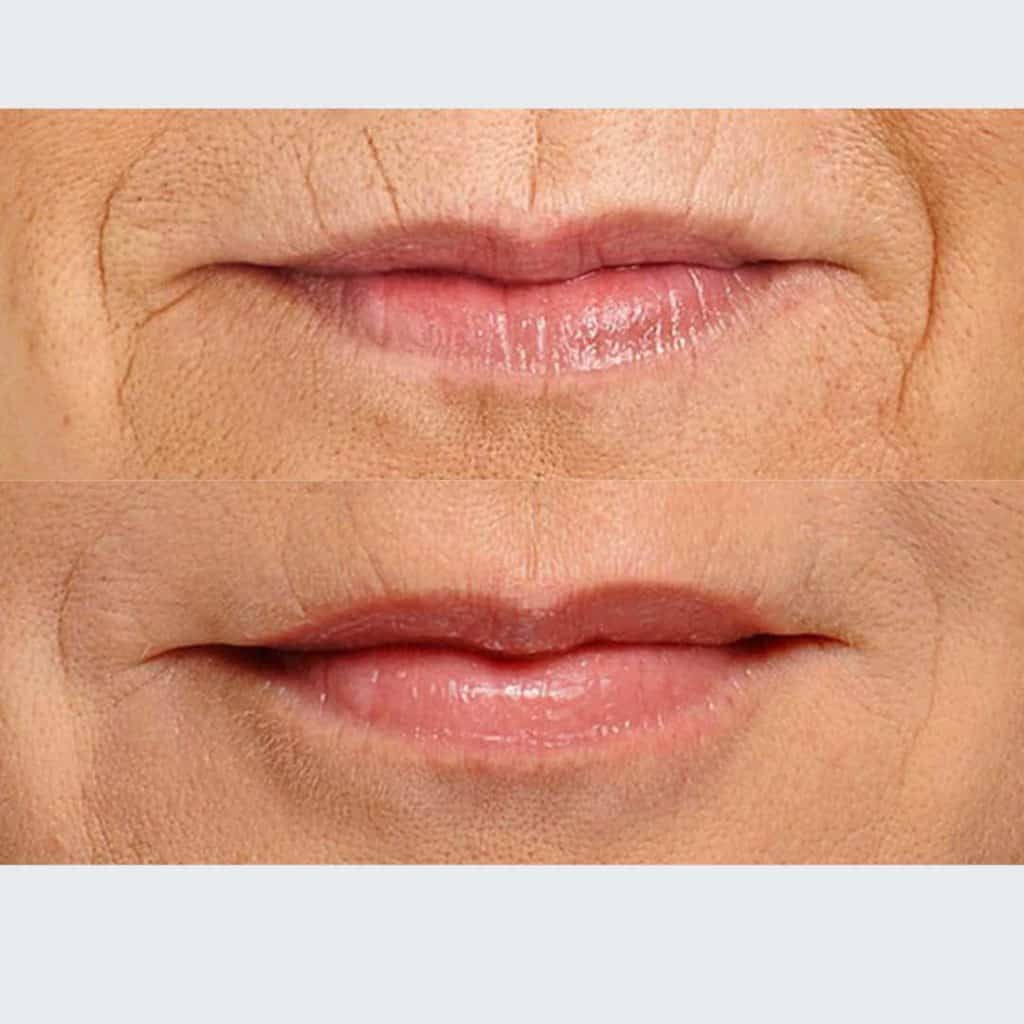 Perioral/Lip Rejuvenation Gallery - Dr Davin Lim